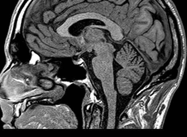 Stem cell trial for stroke victims | BelfastTelegraph.co.uk